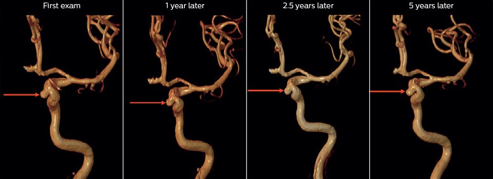 Aneurysms with 3D TOF MRA | FieldStrength | Philips